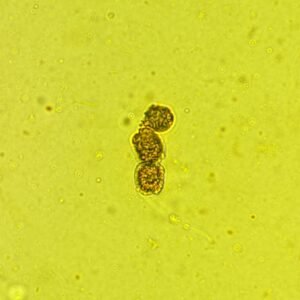 Renal Tubular Epithelial Cell Casts: Identification & Significance ...