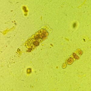 Renal Tubular Epithelial Cell Casts: Identification & Significance ...