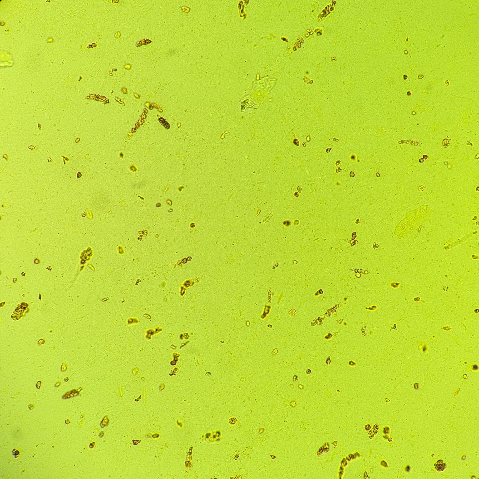 Renal Tubular Epithelial Cell Casts: Identification & Significance ...