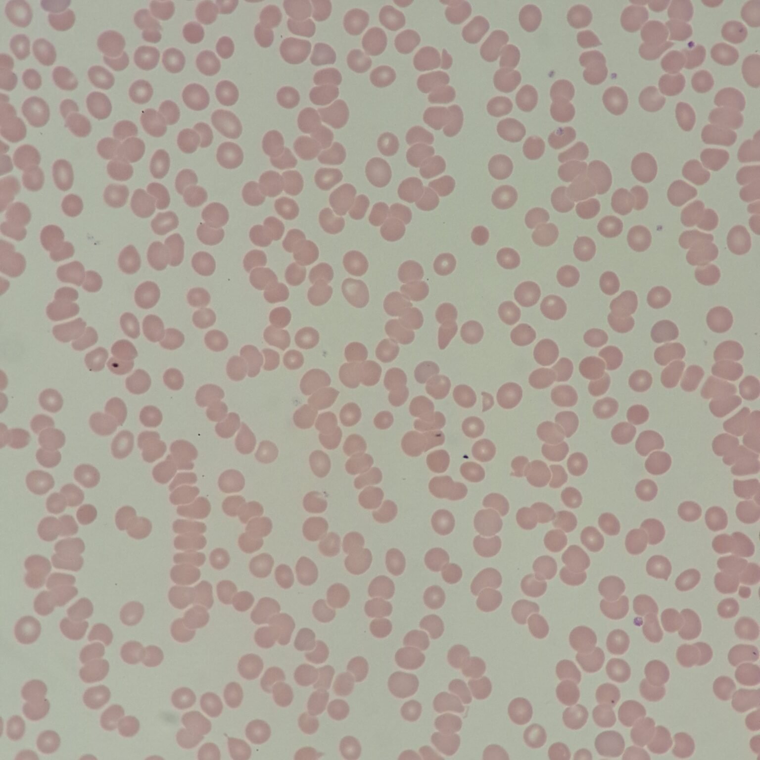 RBC Morphology Based on Shape