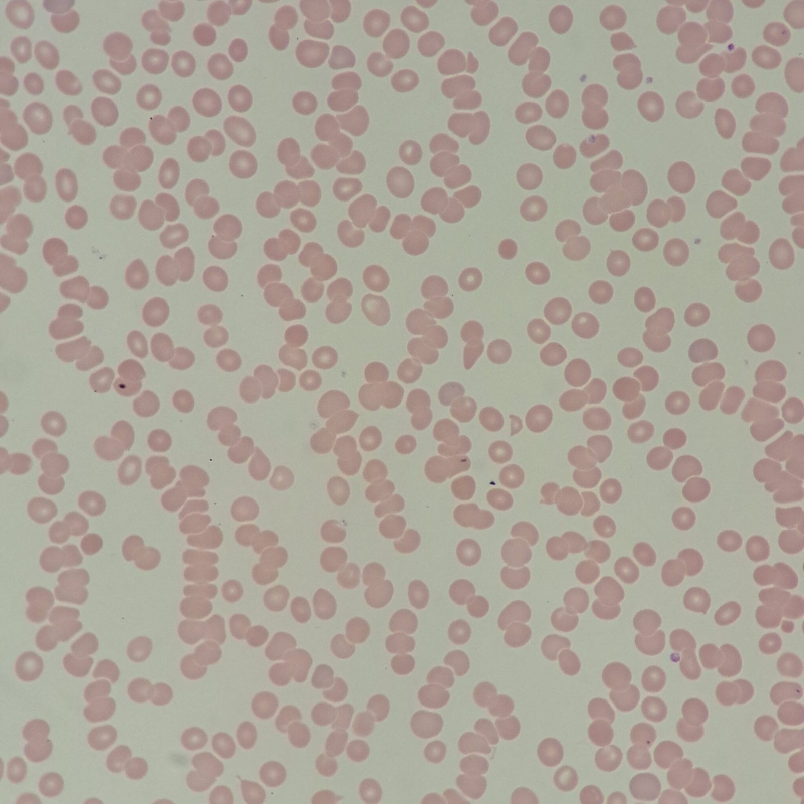 RBC Morphology Based on Shape