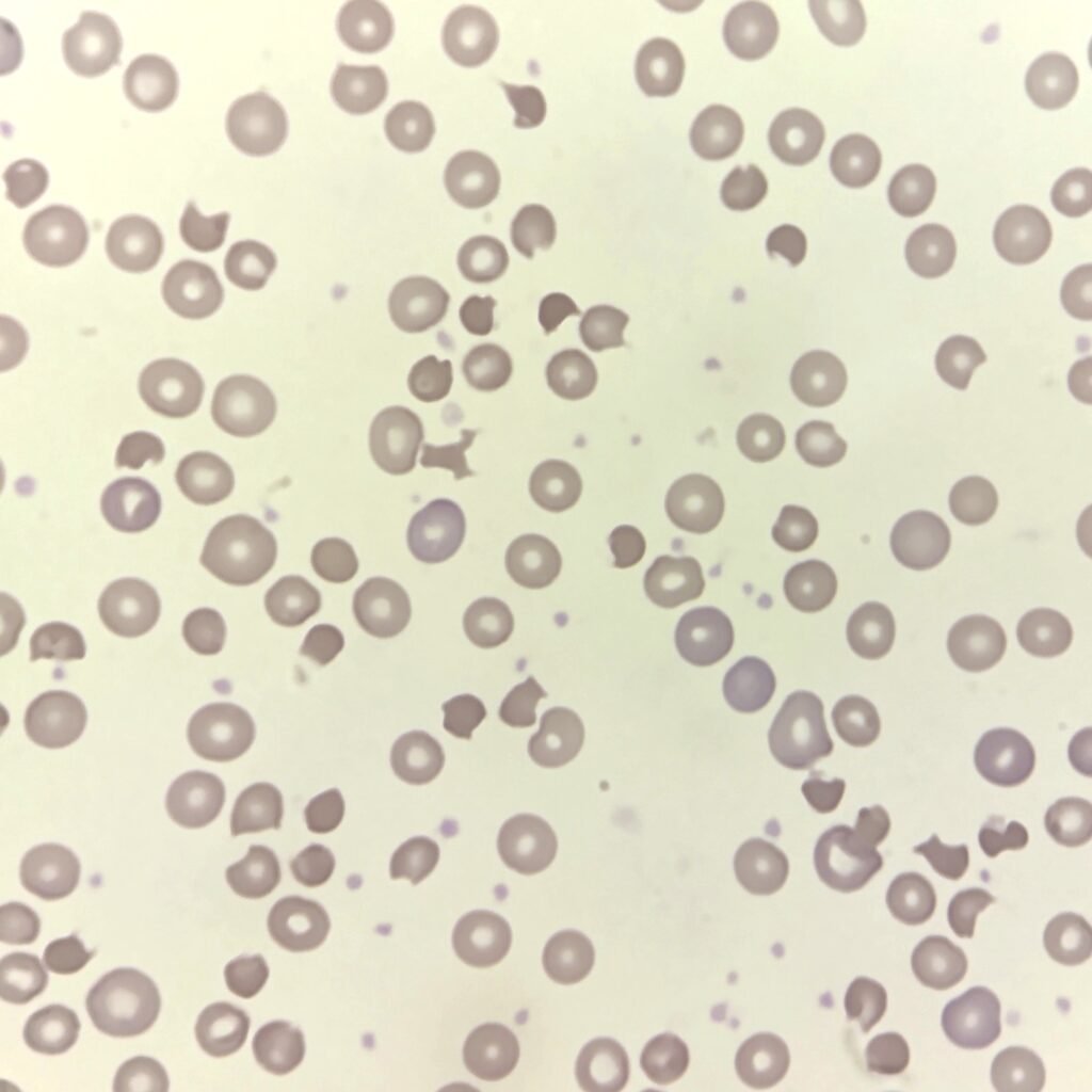 Burr Cells on Blood Smear: Identification & Significance