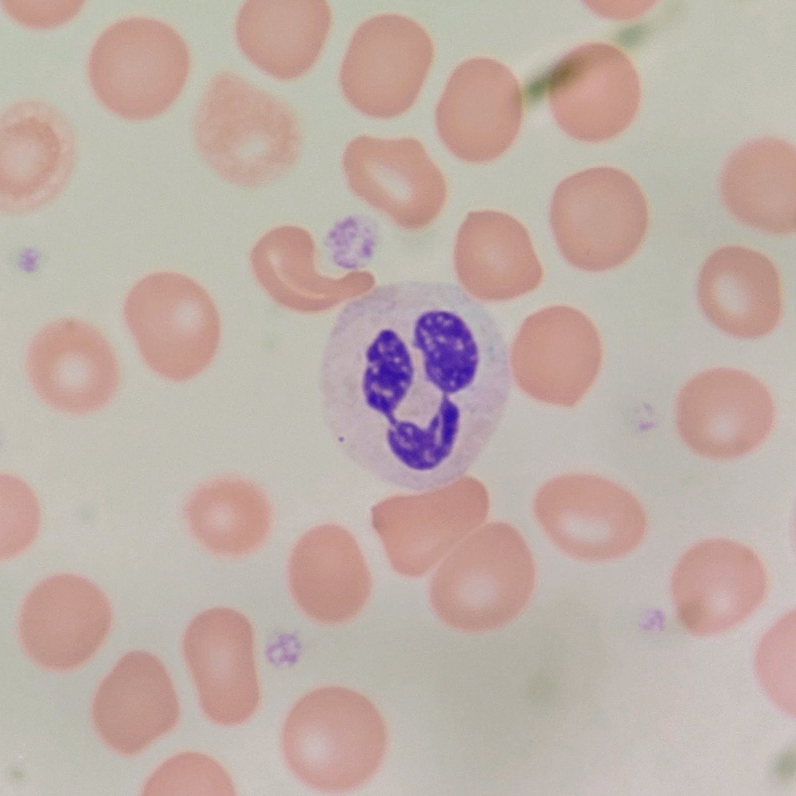Segmented Neutrophils: Identification & Differentiation