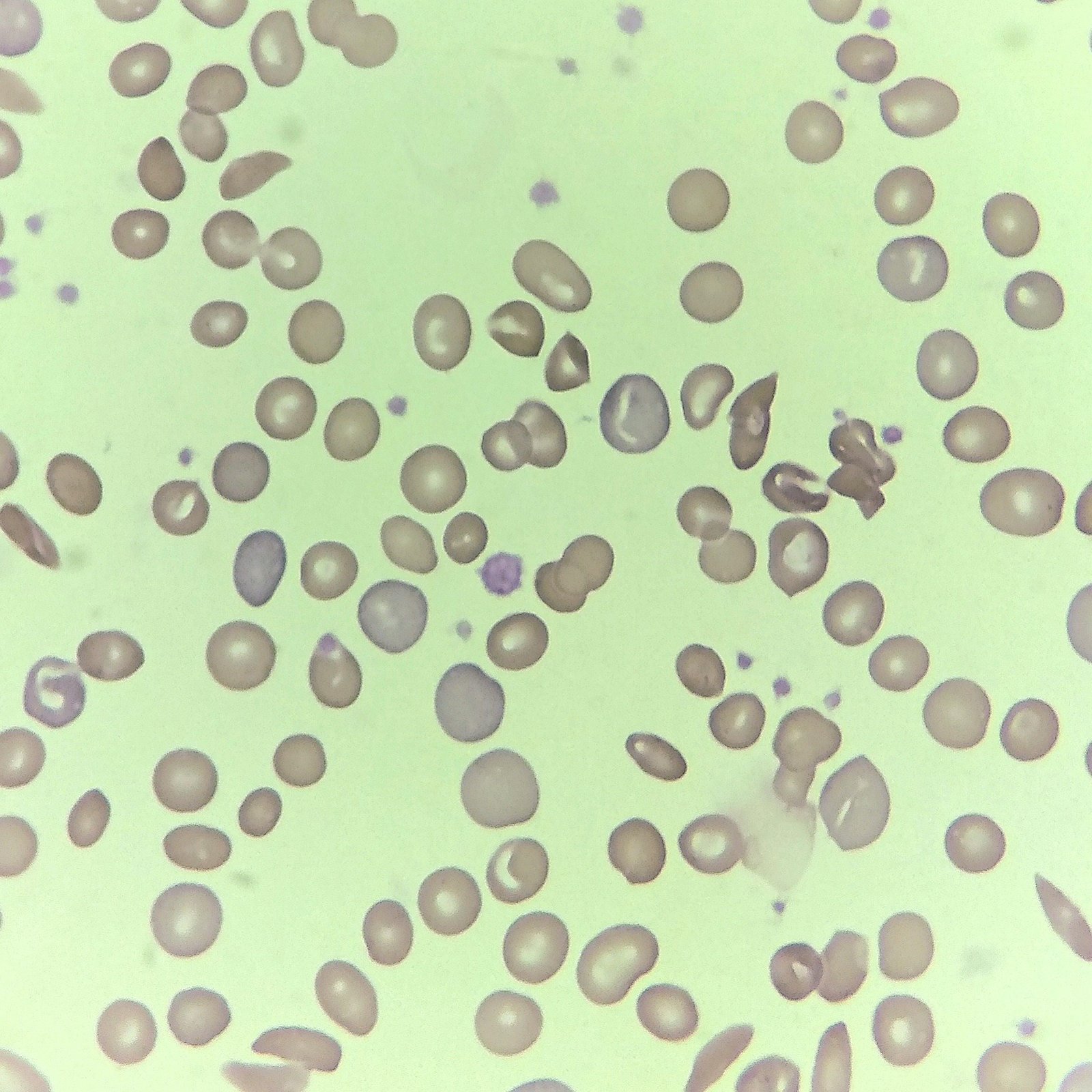 Sickle Cells on Blood Smear: Identification & Significance