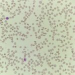 Sickle Cells on Blood Smear: Identification & Significance