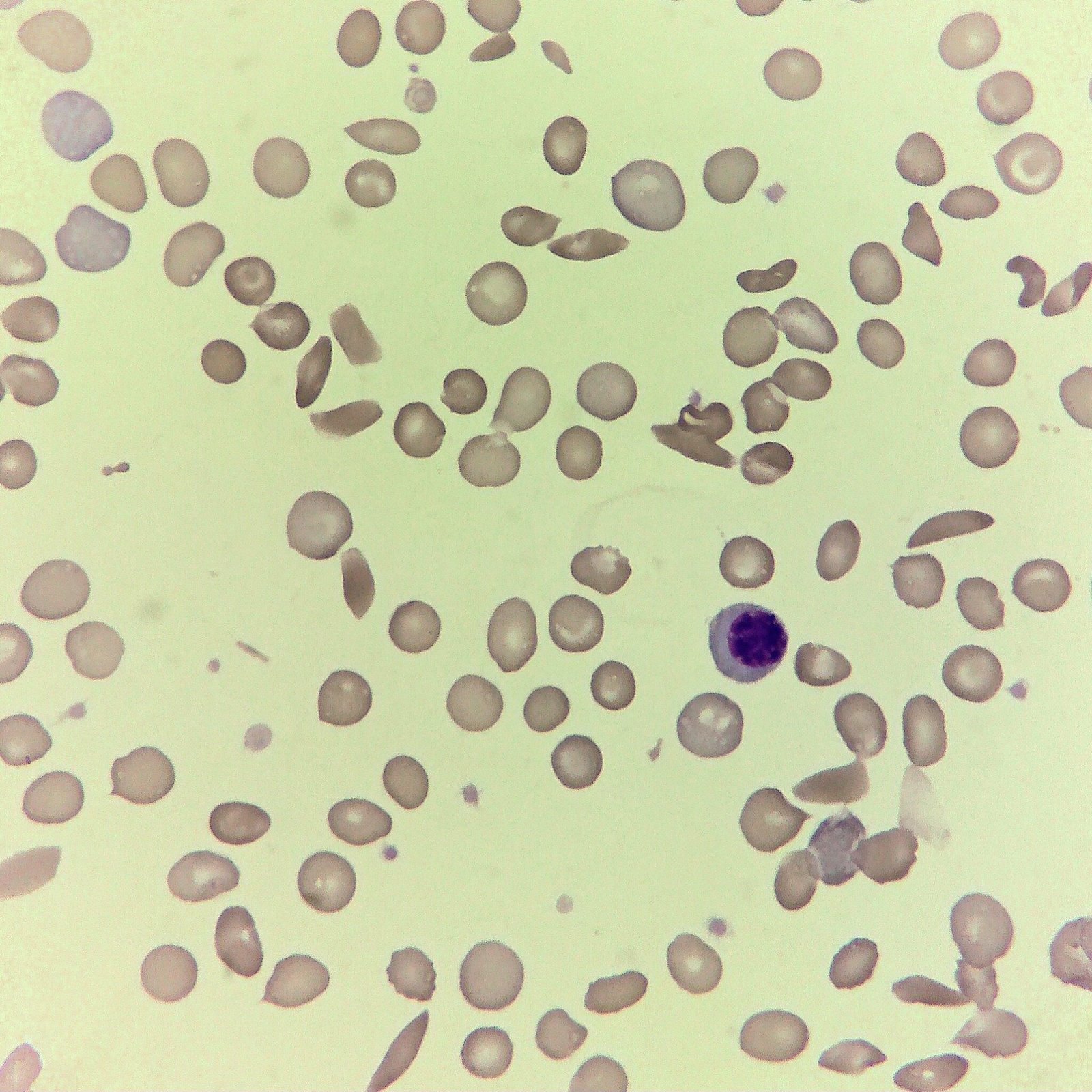 Sickle Cells on Blood Smear: Identification & Significance