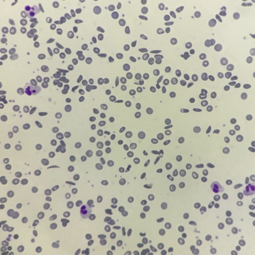 RBC Morphology Based on Shape