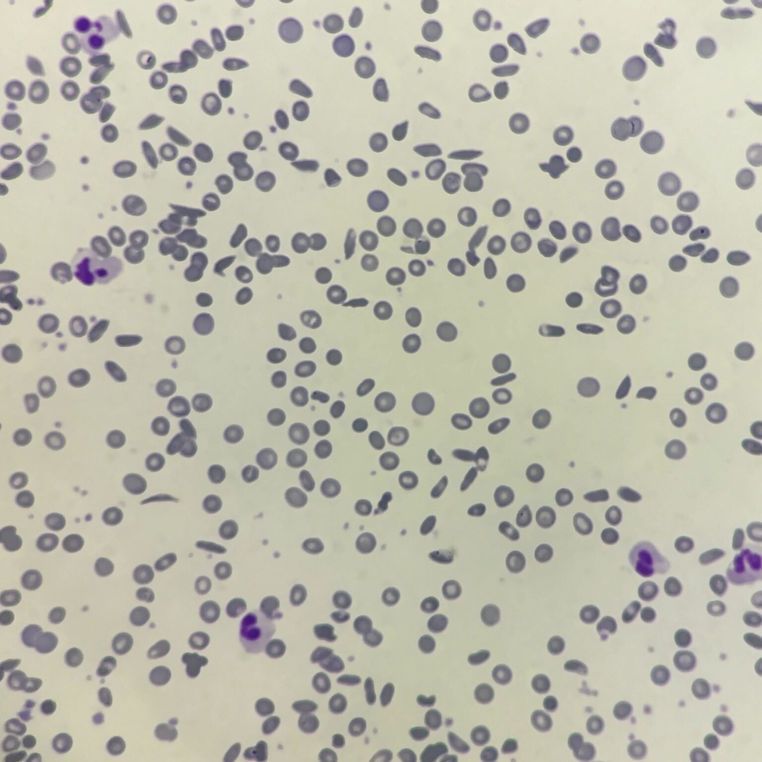 Sickle Cells on Blood Smear: Identification & Significance
