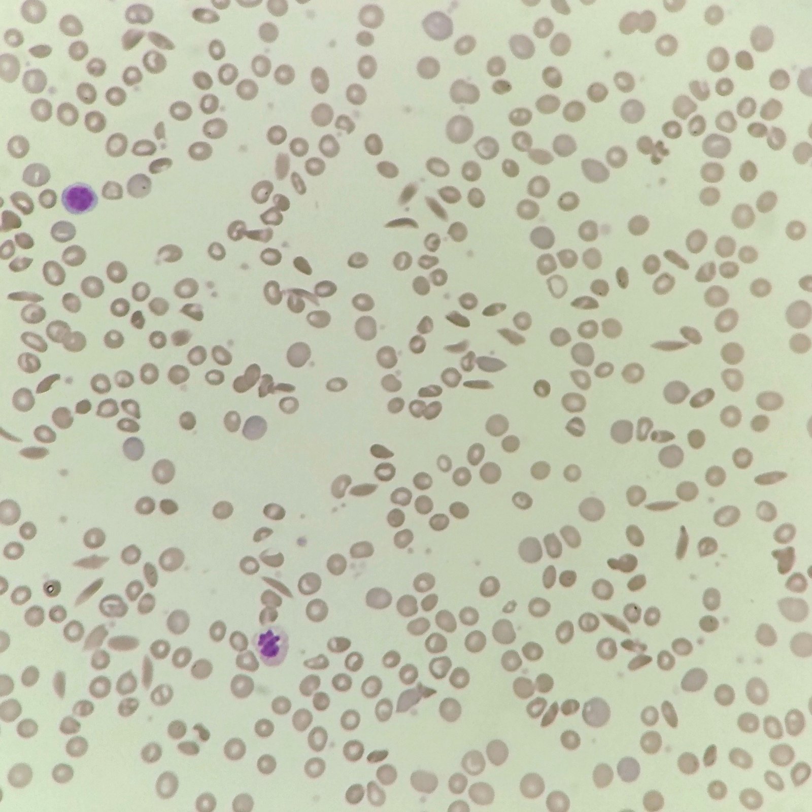 Sickle Cells on Blood Smear: Identification & Significance