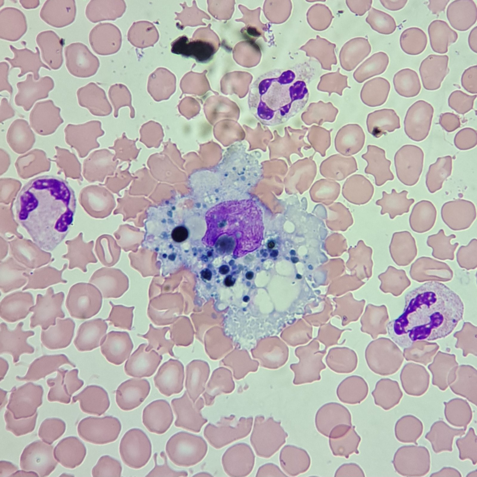 Body Fluid Monocytes / Macrophages - MedLabBuddy