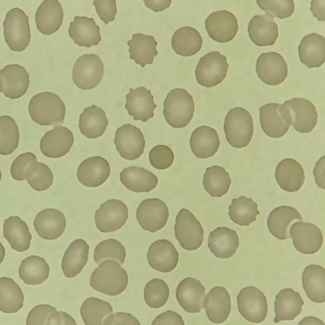 Spherocytes: Appearance & Clinical Significance - MedLabBuddy