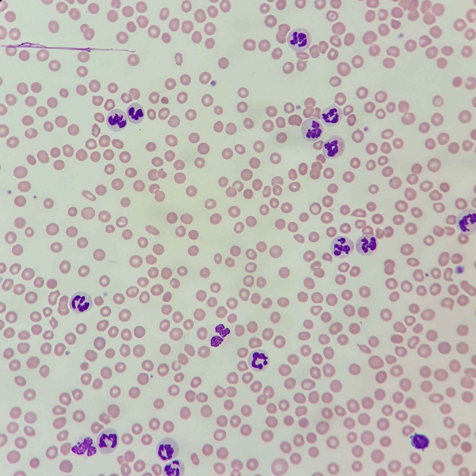 Spherocytes: Appearance & Clinical Significance - MedLabBuddy