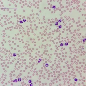 Spherocytes: Appearance & Clinical Significance - MedLabBuddy