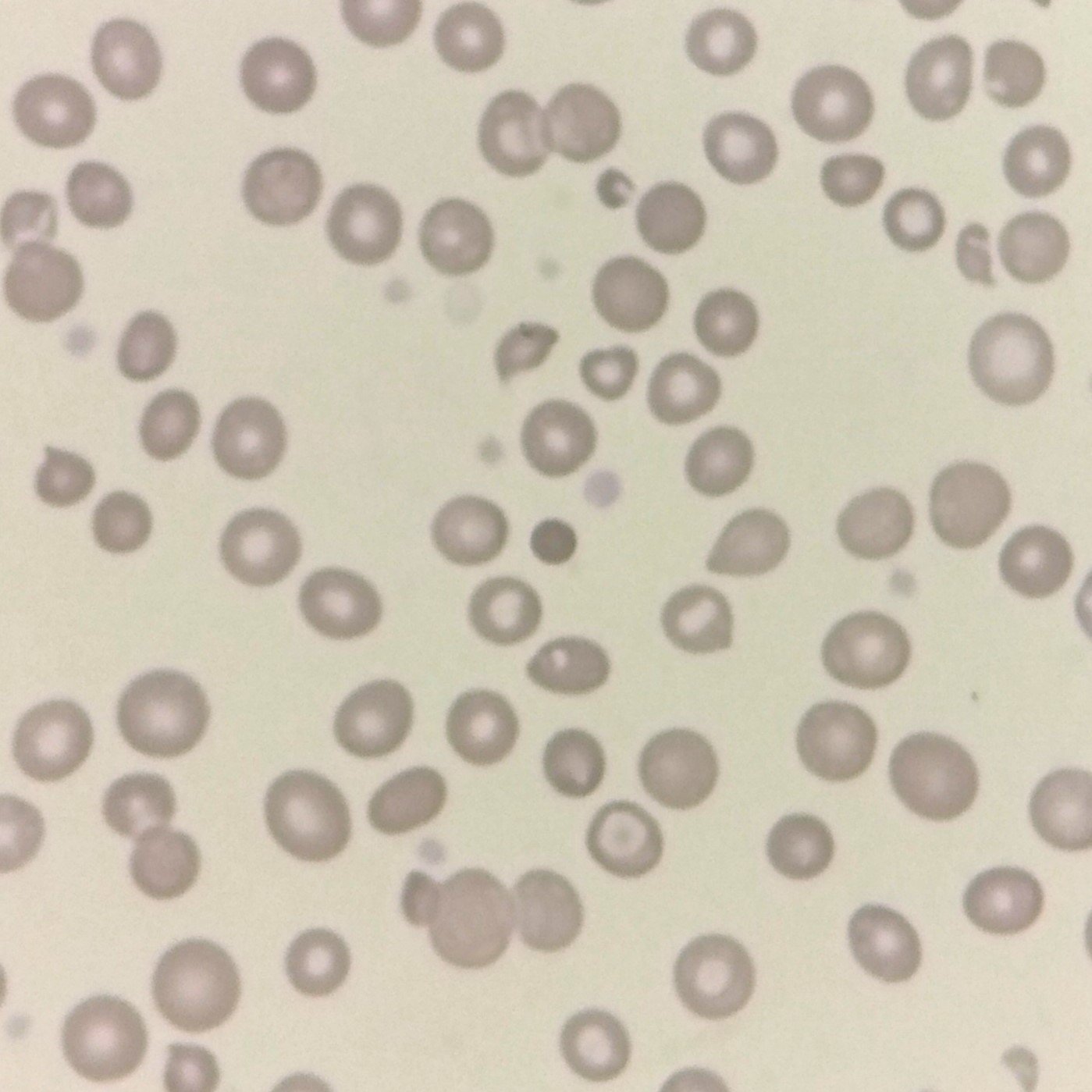 Spherocytes: Appearance & Clinical Significance - MedLabBuddy