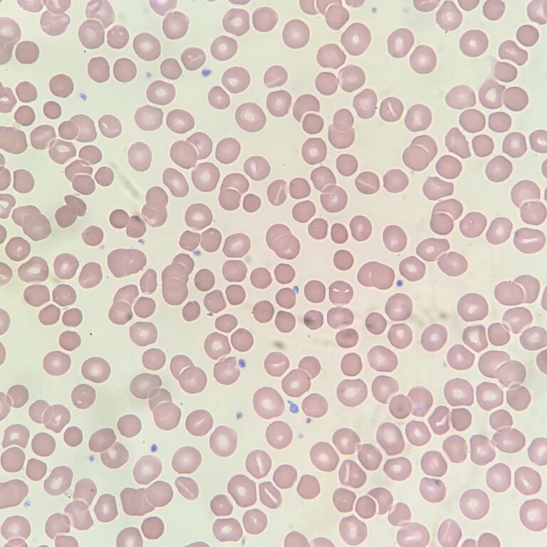 Spherocytes: Appearance & Clinical Significance - MedLabBuddy