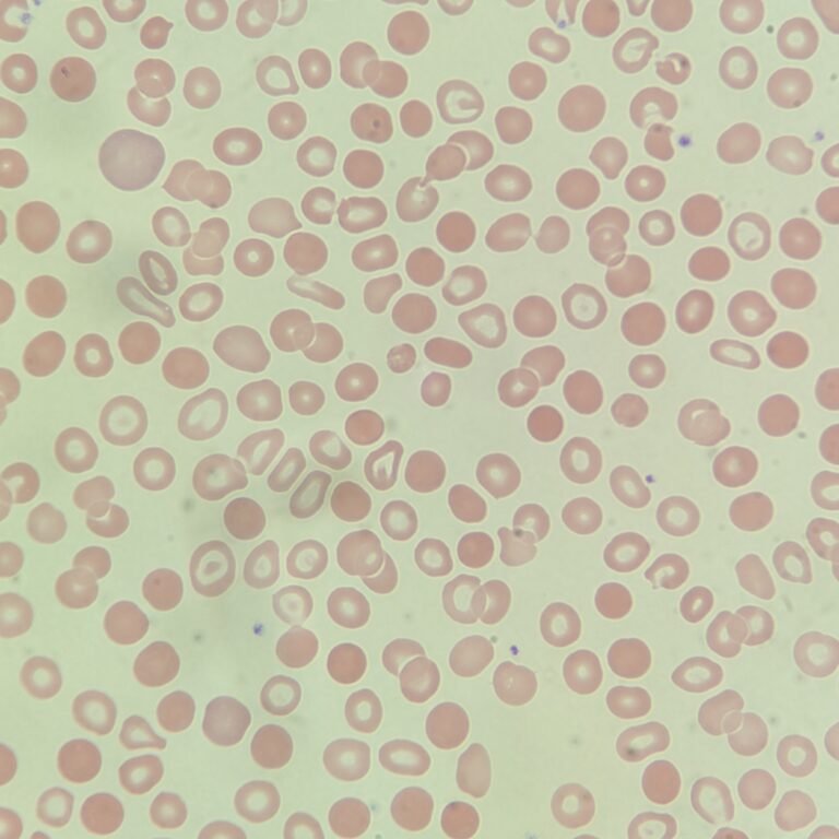 Spherocytes: Appearance & Clinical Significance - MedLabBuddy