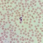 Pappenheimer Bodies - MedLabBuddy