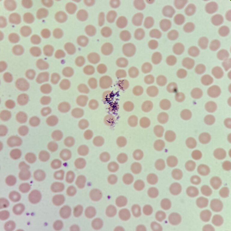 Pappenheimer Bodies - MedLabBuddy