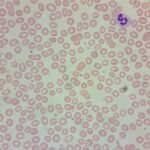 Stomatocytes: Appearance & Clinical Significance - MedLabBuddy