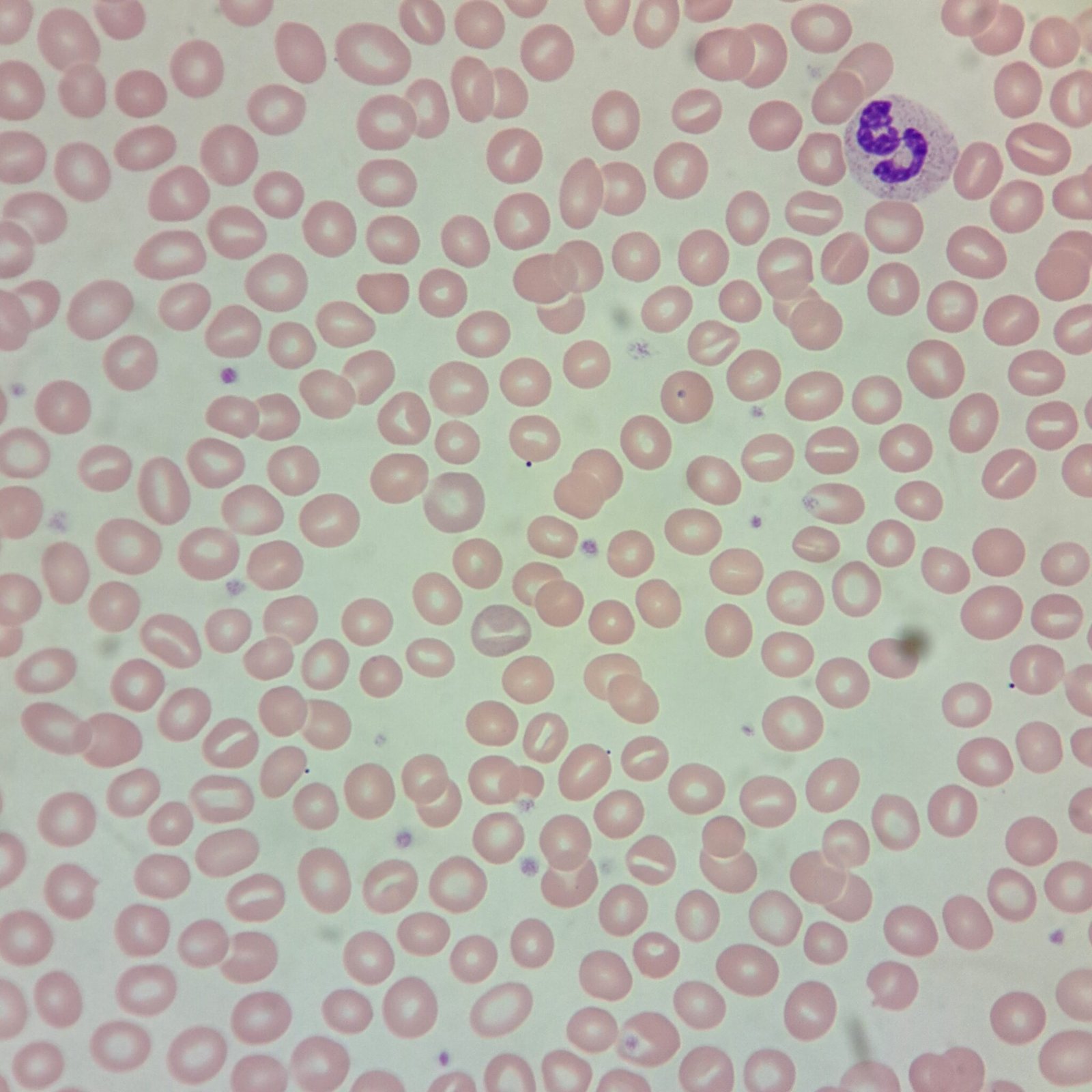 RBC Morphology Based on Shape