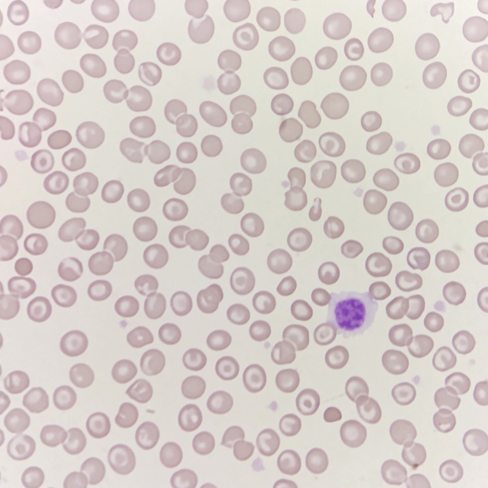 Target Cells: Appearance & Clinical Significance - MedLabBuddy