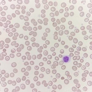 Target Cells: Appearance & Clinical Significance - MedLabBuddy