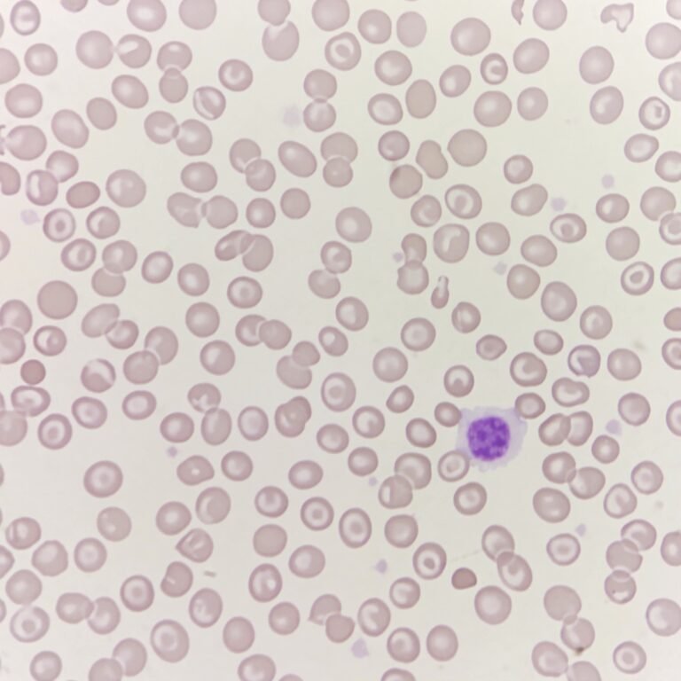 Target Cells: Appearance & Clinical Significance - MedLabBuddy