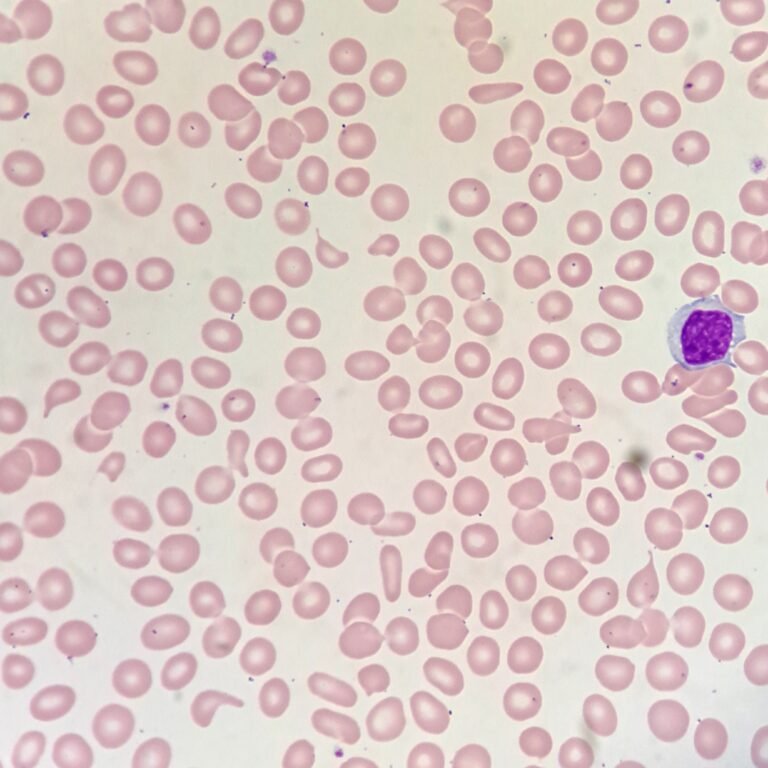 Teardrop Cells: Appearance & Clinical Significance - MedLabBuddy