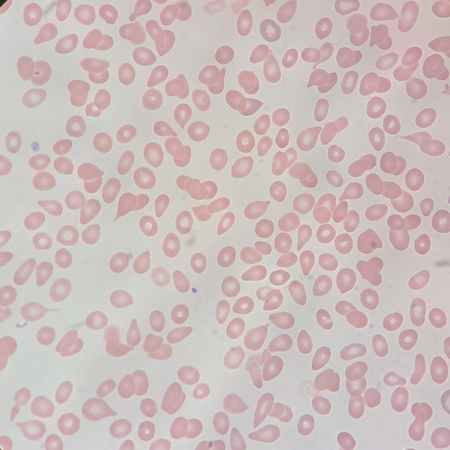 Teardrop Cells: Appearance & Clinical Significance - MedLabBuddy