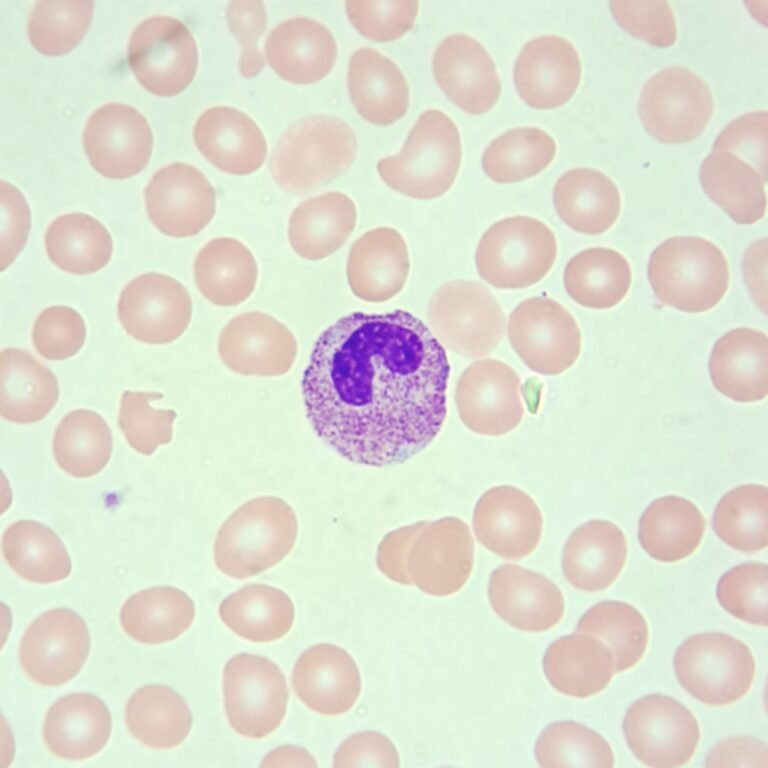 Toxic Granulation: Appearance & Clinical Significance - MedLabBuddy