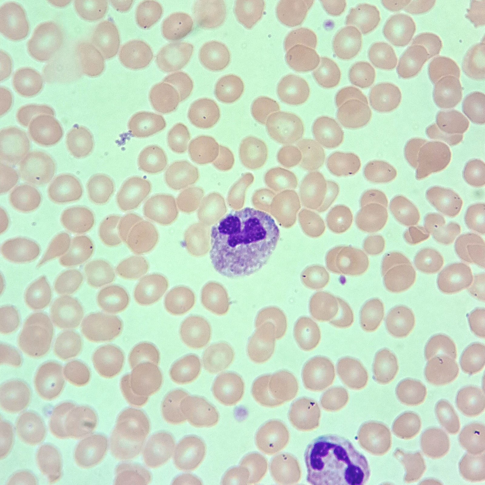 Toxic Granulation: Appearance & Clinical Significance - MedLabBuddy