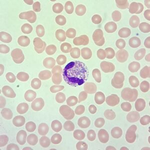 Toxic Granulation: Appearance & Clinical Significance - MedLabBuddy