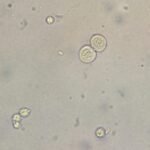 Transitional Epithelial Cells - MedLabBuddy