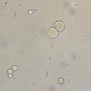 Transitional Epithelial Cells - MedLabBuddy