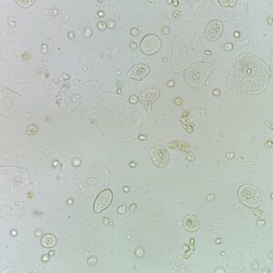 Transitional Epithelial Cells - MedLabBuddy