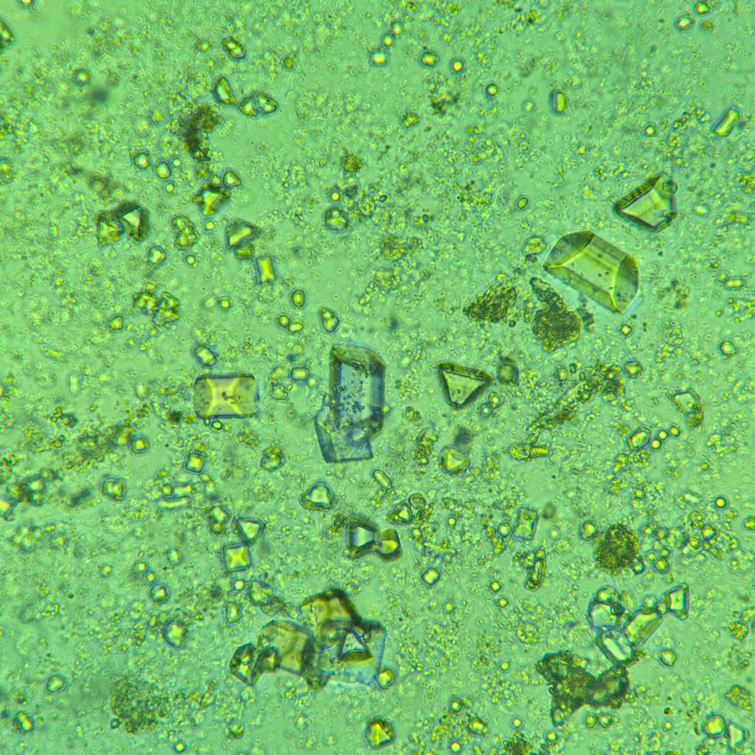 Triple Phosphate Crystals: Identification & Clinical Significance
