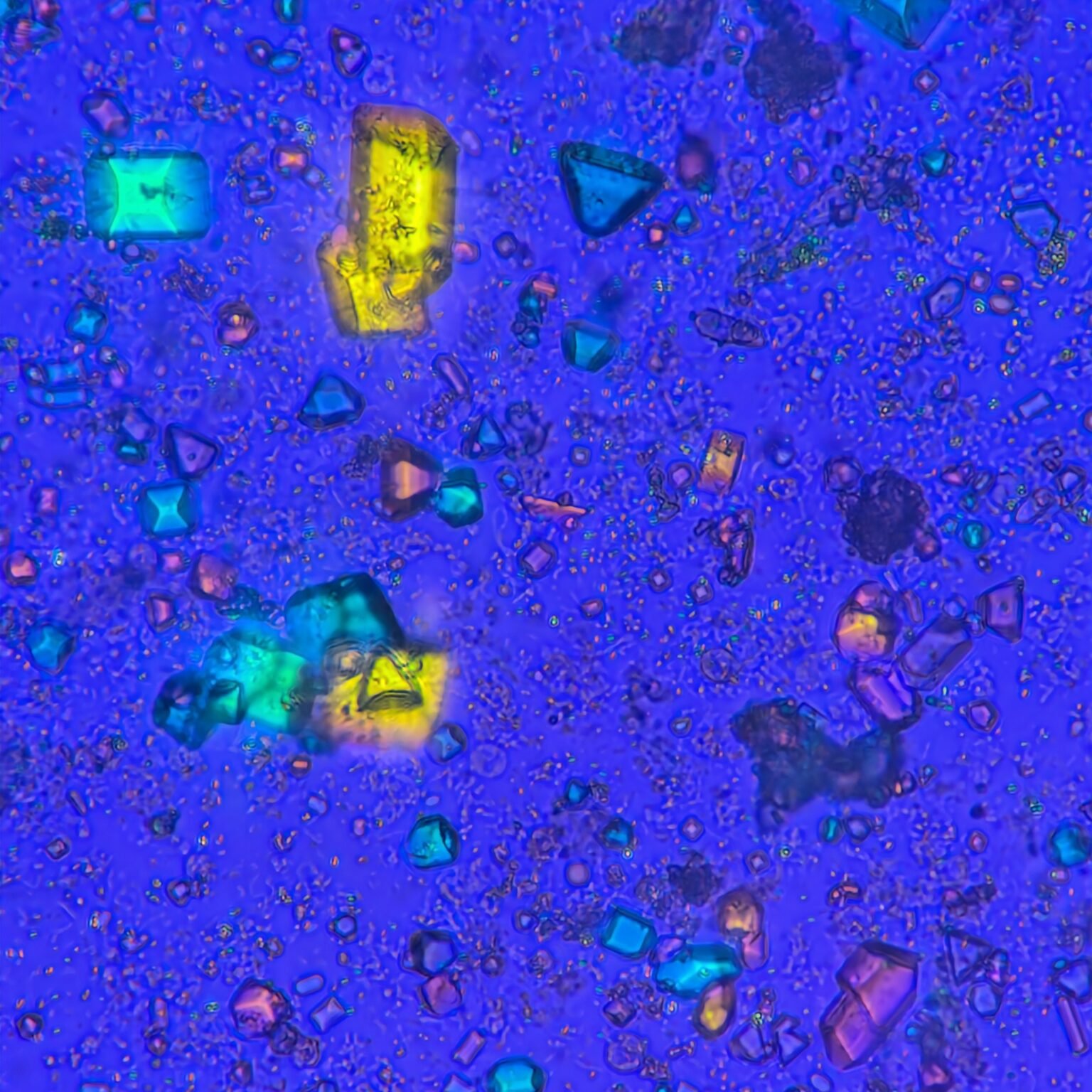 Triple Phosphate Crystals: Identification & Clinical Significance