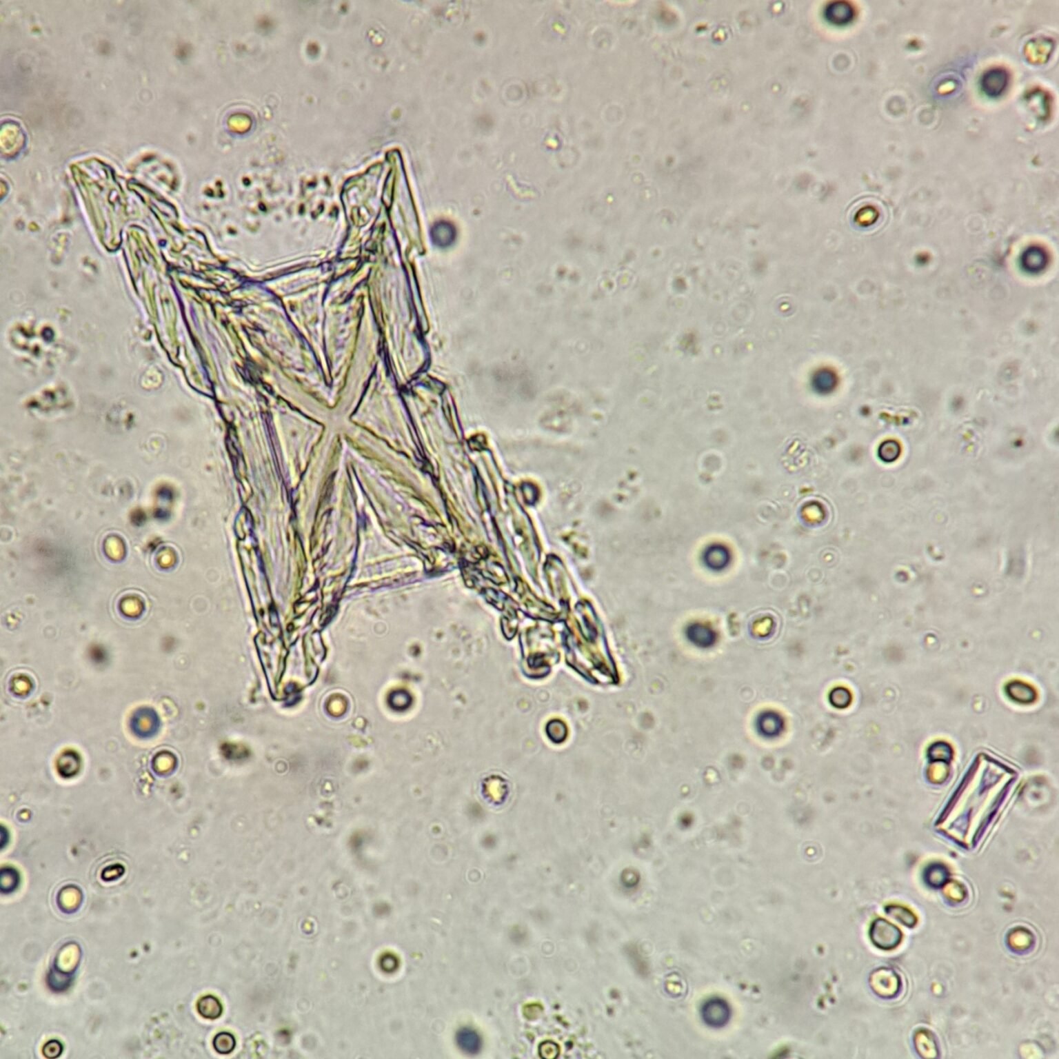 Triple Phosphate Crystals: Identification & Clinical Significance