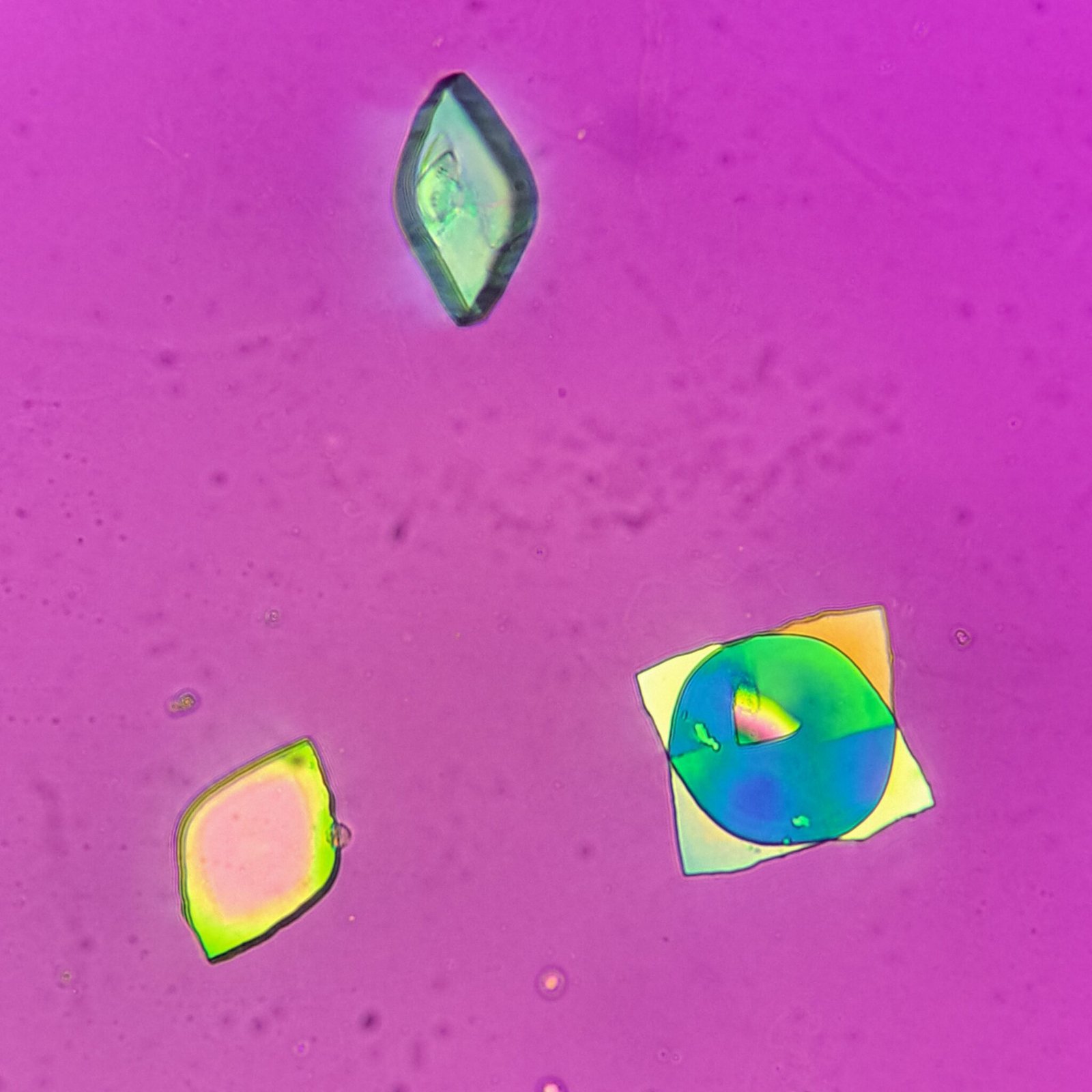 Uric Acid Crystals: Identification & Clinical Significance