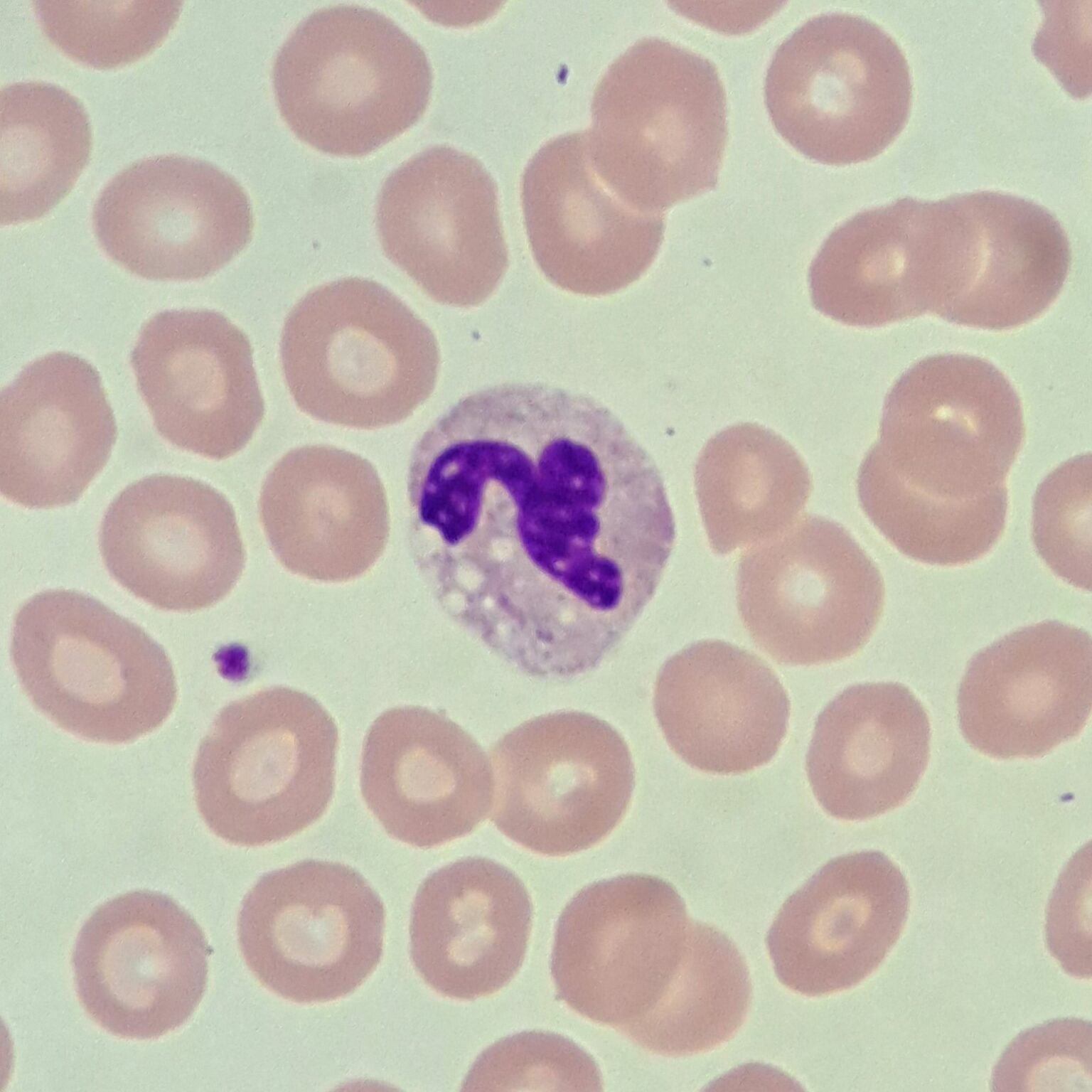 Vacuolization: Appearance & Clinical Significance - MedLabBuddy