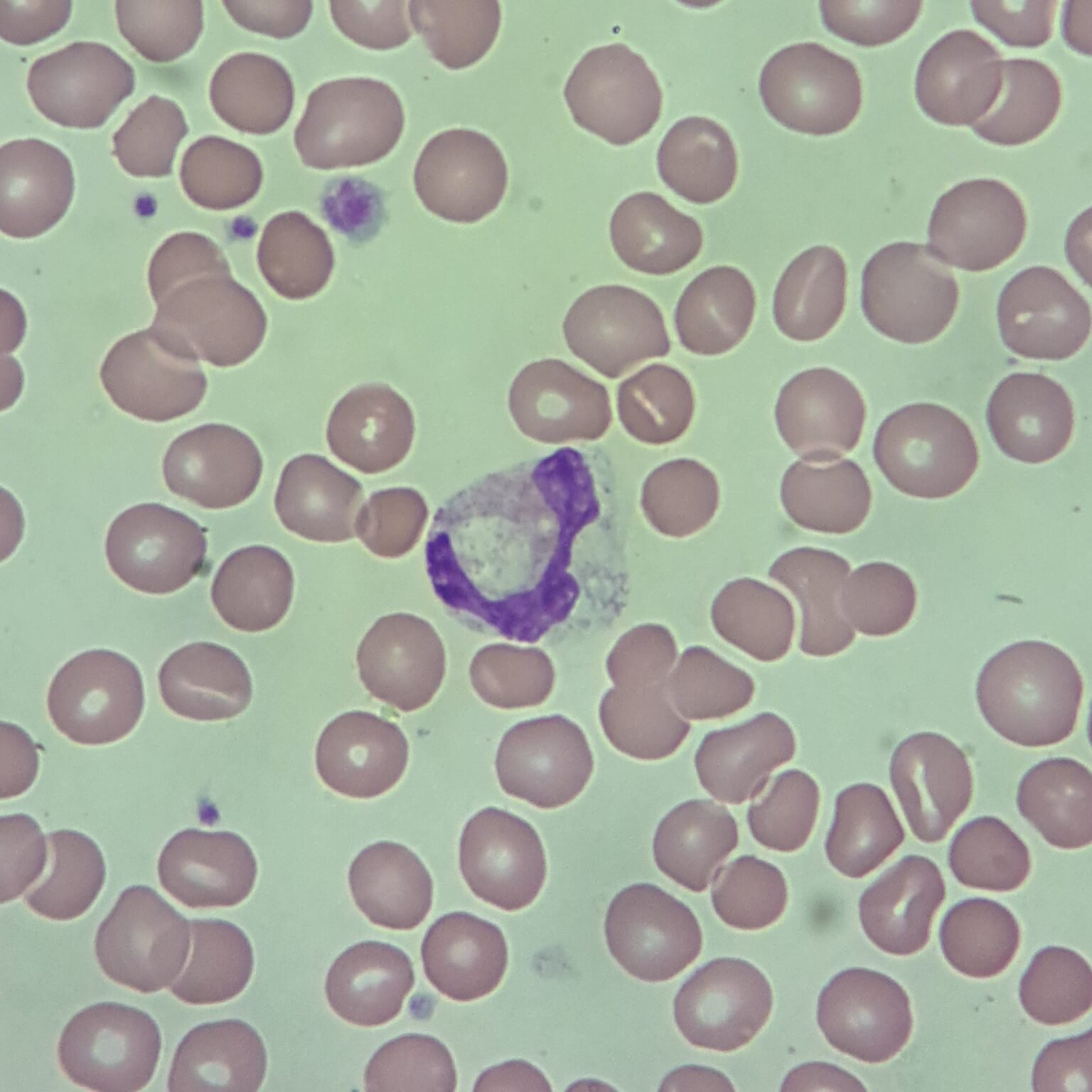 Vacuolization: Appearance & Clinical Significance - MedLabBuddy