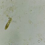 White Blood Cell Casts: Identification & Significance - MedLabBuddy