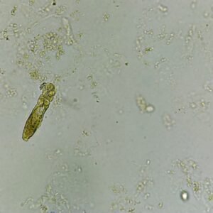 White Blood Cell Casts: Identification & Significance - MedLabBuddy