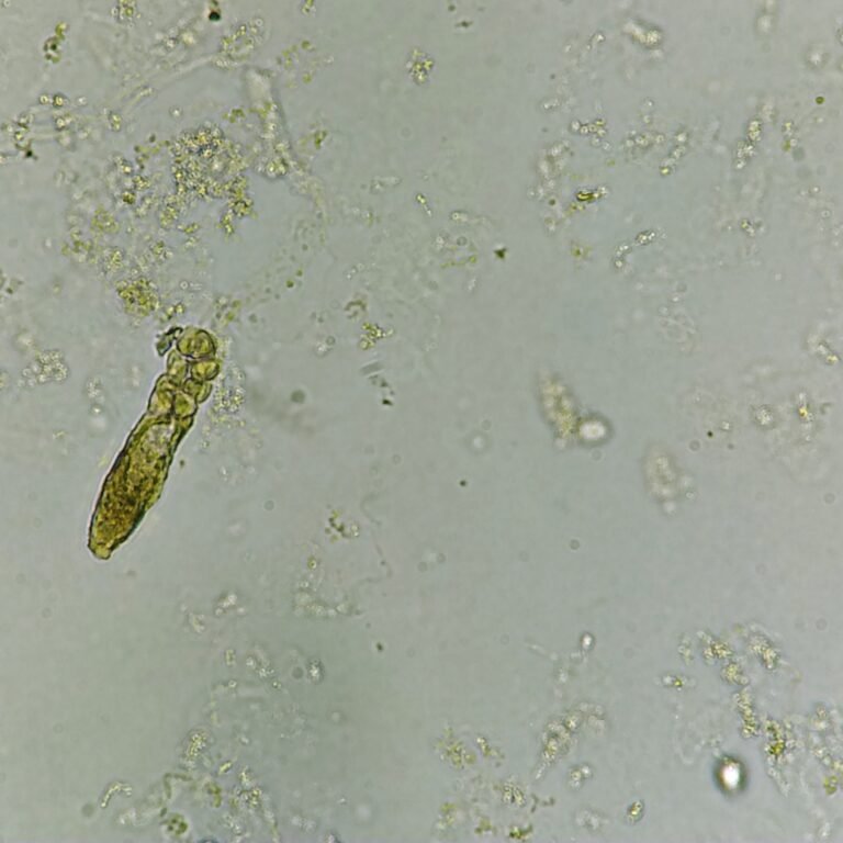 White Blood Cell Casts: Identification & Significance - MedLabBuddy