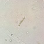 White Blood Cell Casts: Identification & Significance - MedLabBuddy