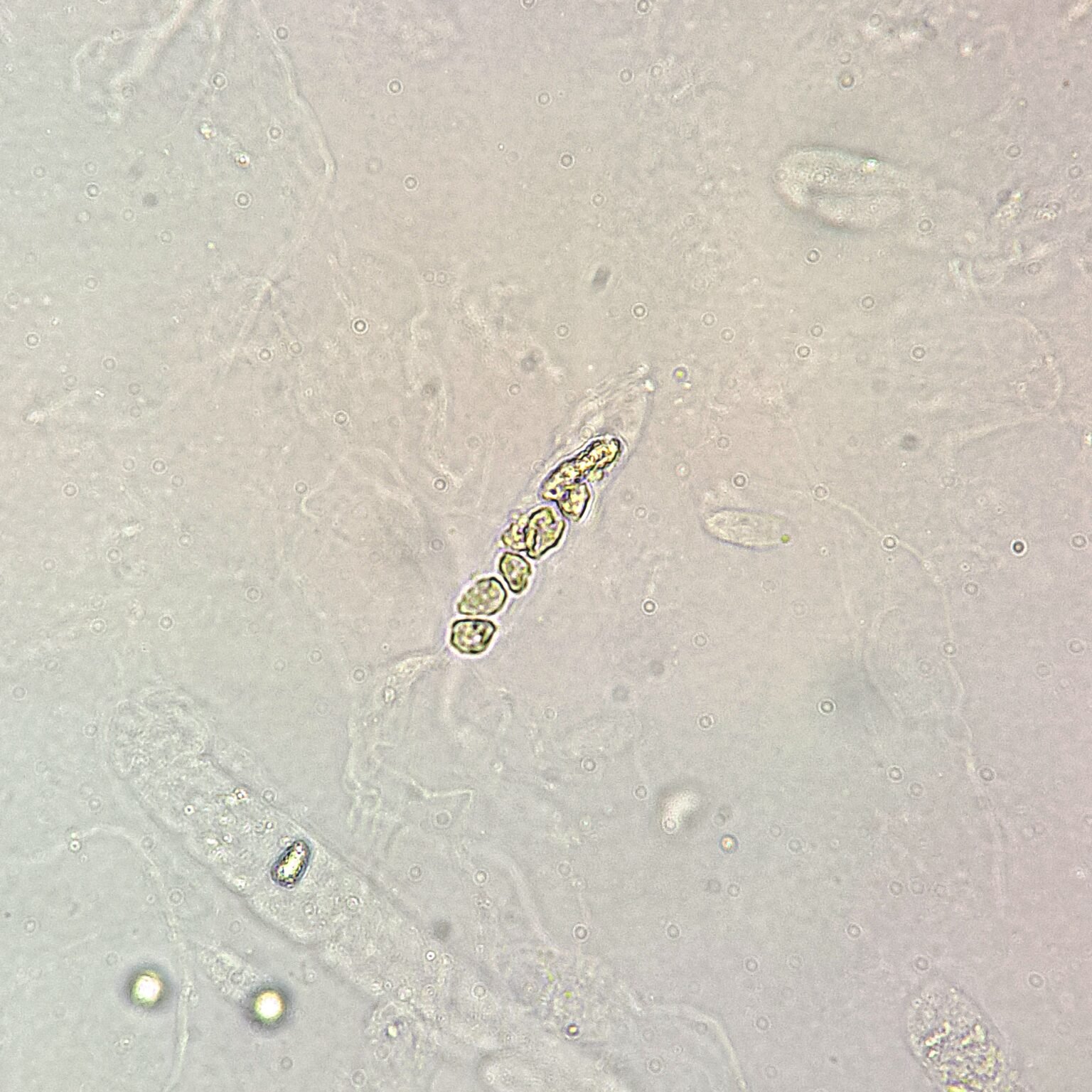 White Blood Cell Casts: Identification & Significance - MedLabBuddy