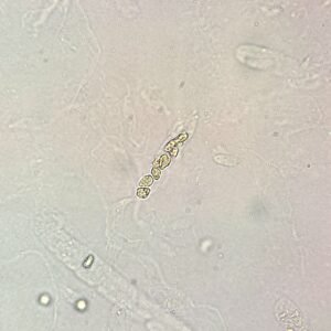 White Blood Cell Casts: Identification & Significance - MedLabBuddy
