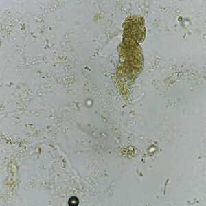 Urinary Casts: Identification & Significance