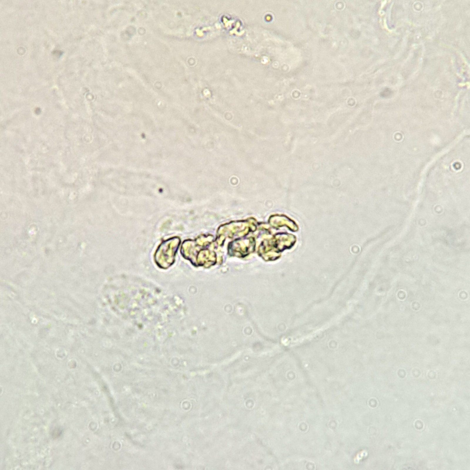 White Blood Cell Casts: Identification & Significance - MedLabBuddy