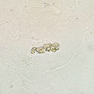 White Blood Cell Casts: Identification & Significance - MedLabBuddy